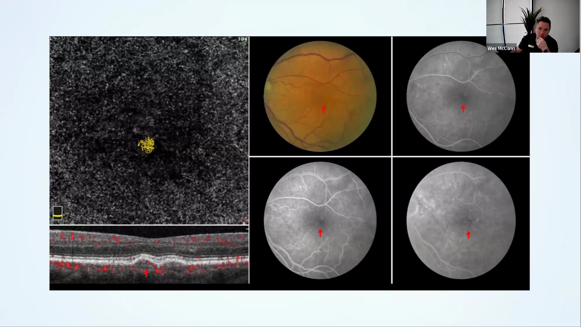 OCTA in optometry practices with ZEISS CIRRUS 6000