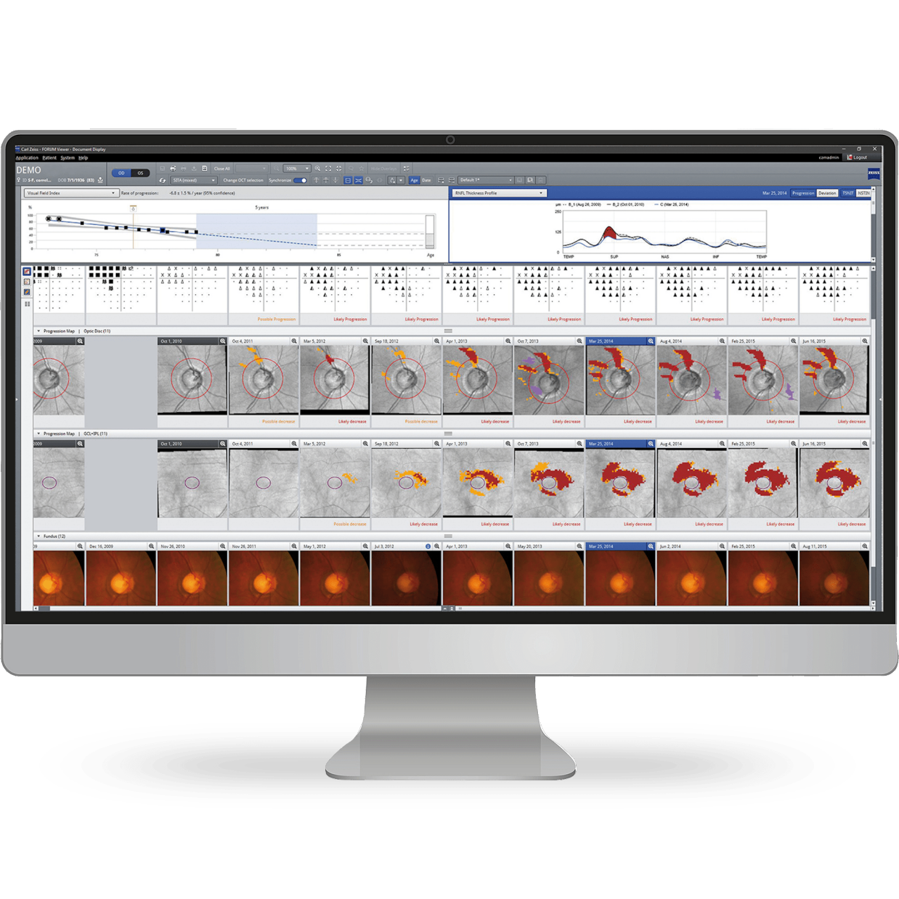ZEISS Glaucoma