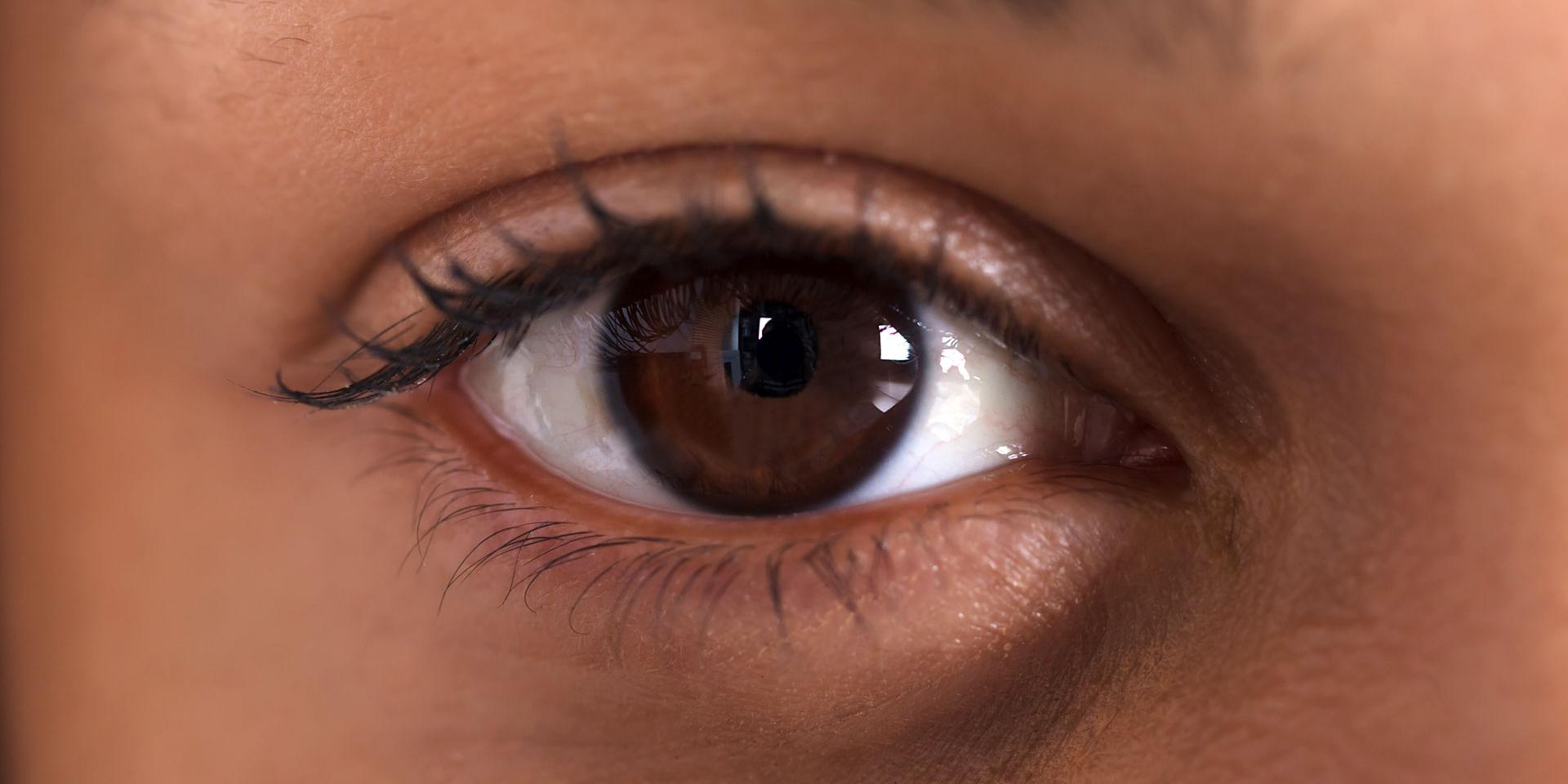 Yeux gonflés, cerné ; rougeur et sensation de brûlure oculaires