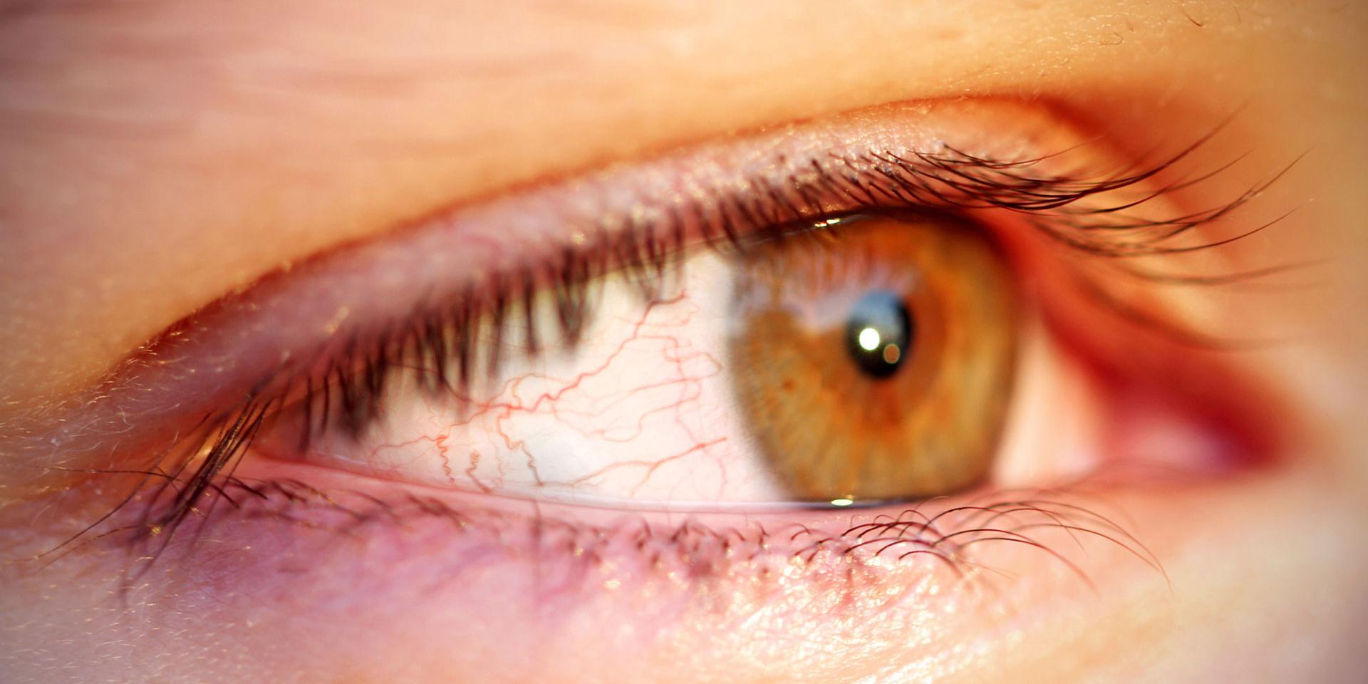 Yeux gonflés, cerné ; rougeur et sensation de brûlure oculaires